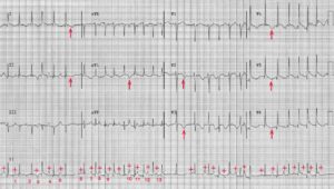 ECG Case 129: Multifocal Atrial Tachycardia (MAT) - Manual of Medicine