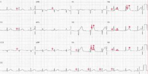 ECG Case 134: Acute Anterior MI - Manual of Medicine
