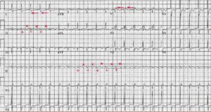 ECG Case 138: Atrial Flutter with 2:1 Conduction and RBBB - Manual of ...
