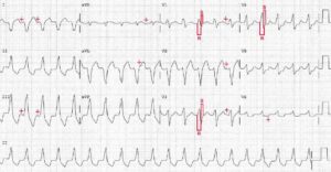 ECG Case 133: Monomorphic Ventricular Tachycardia - Manual of Medicine