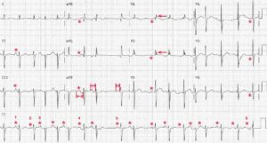 ECG Case 141: Multifocal Atrial Tachycardia (MAT) - Manual of Medicine