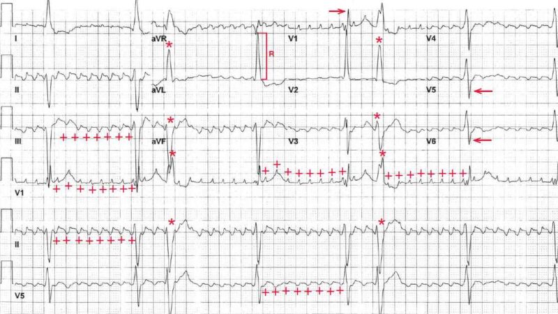 Ecg Case 143 Atrial Flutter With 8 1 Conduction Pvcs And