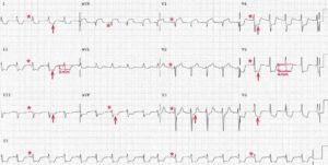 ECG Case 146: Diffuse Subendocardial Ischemia - Manual of Medicine