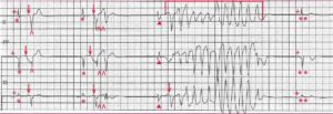 ECG Case 144: Nonsustained Polymorphic Ventricular Tachycardia - Manual ...