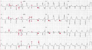 ECG Case 145: Sustained Monomorphic Ventricular Tachycardia - Manual of ...
