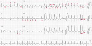 ECG Case 150: Atrial Fibrillation with Rapid Ventricular Response (RVR ...