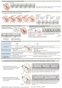 Conduction Blocks at the AV Node (AV Blocks) [With Examples] - Manual ...