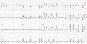 ECG Case 150 - Manual of Medicine