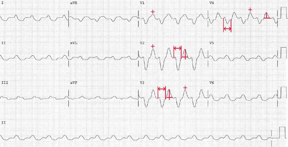Hyperkalemia Peaked Waves Ekg Wave Pulseless Electrical Activity