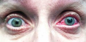 Severe Pain and Blurred Vision in the Left Eye - Manual of Medicine