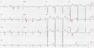 ECG Case 155: Sinus Tachycardia with Intraventricular Conduction Delay ...