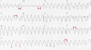 ECG Case 153: Ventricular Tachycardia and Hyperkalemia - Manual of Medicine