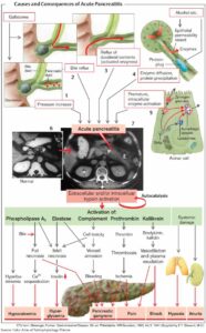 Acute Pancreatitis: Approach, Evaluation and Management - Manual of ...