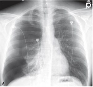 Patient with Pleuritic Chest Pain and Shortness of Breath - Manual of ...