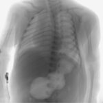 Infant with Vomiting and Abdominal Mass - Manual of Medicine