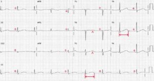 ECG Case 159: Long QT Syndrome (LQTS) - Manual of Medicine