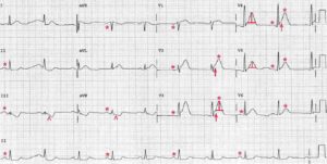 ECG Case 160: Acute Anterior Wall MI (STEMI) - Manual of Medicine
