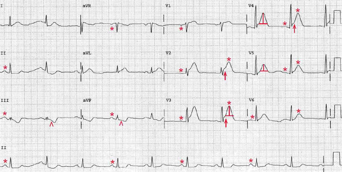 Stemi