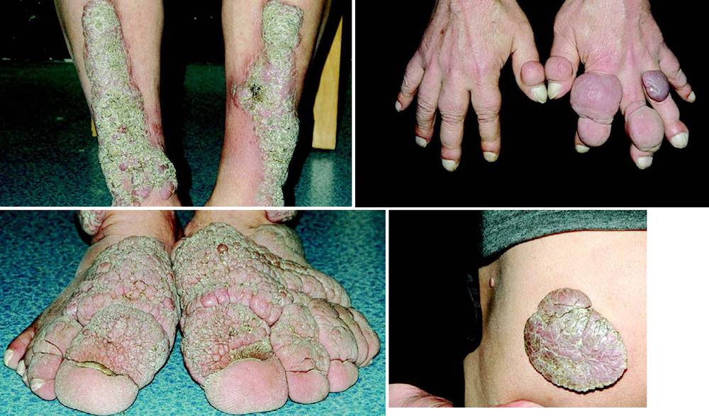 Leathery Verrucous Plaques and Nodules - Manual of Medicine