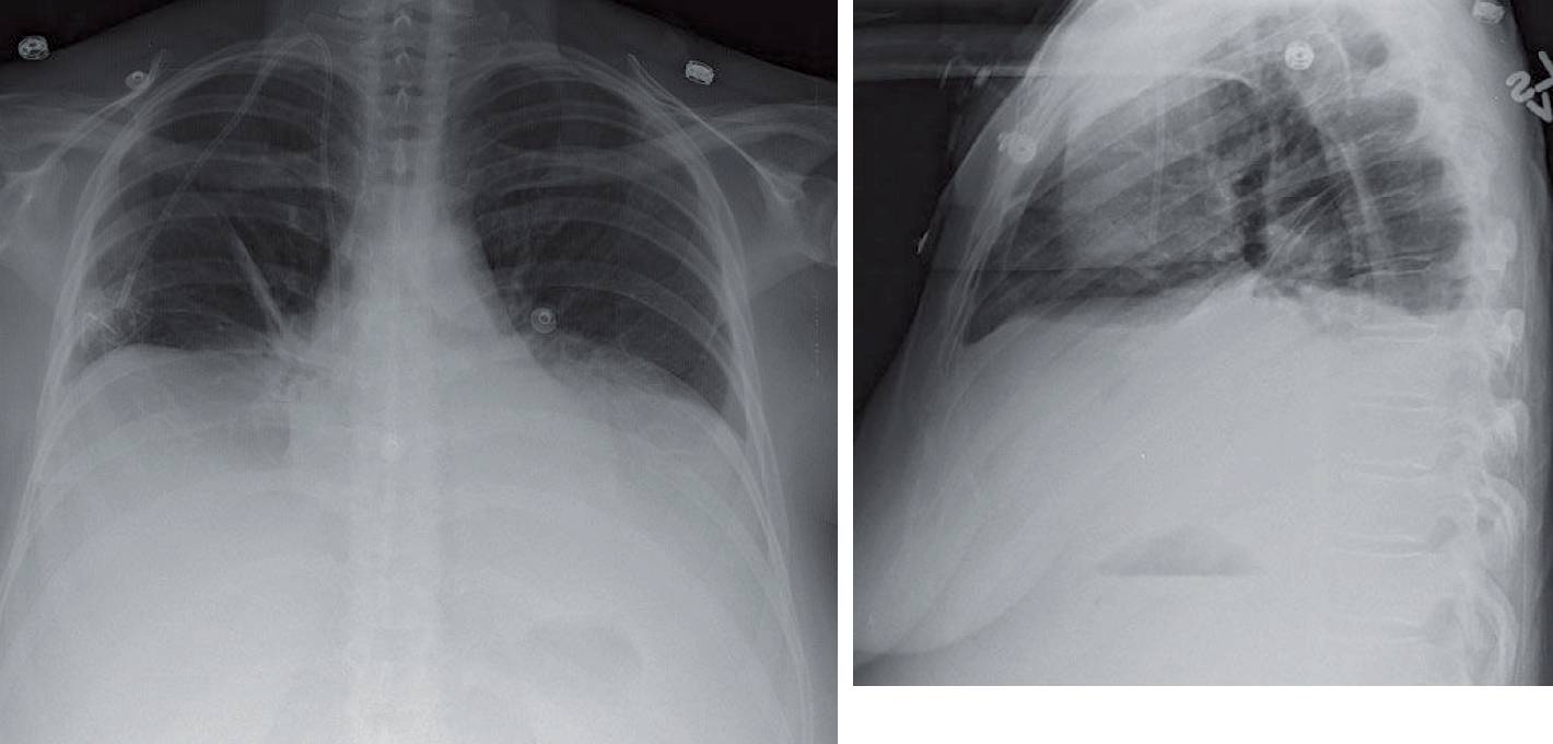 Bilateral Subpulmonic Pleural Effusions - Manual of Medicine