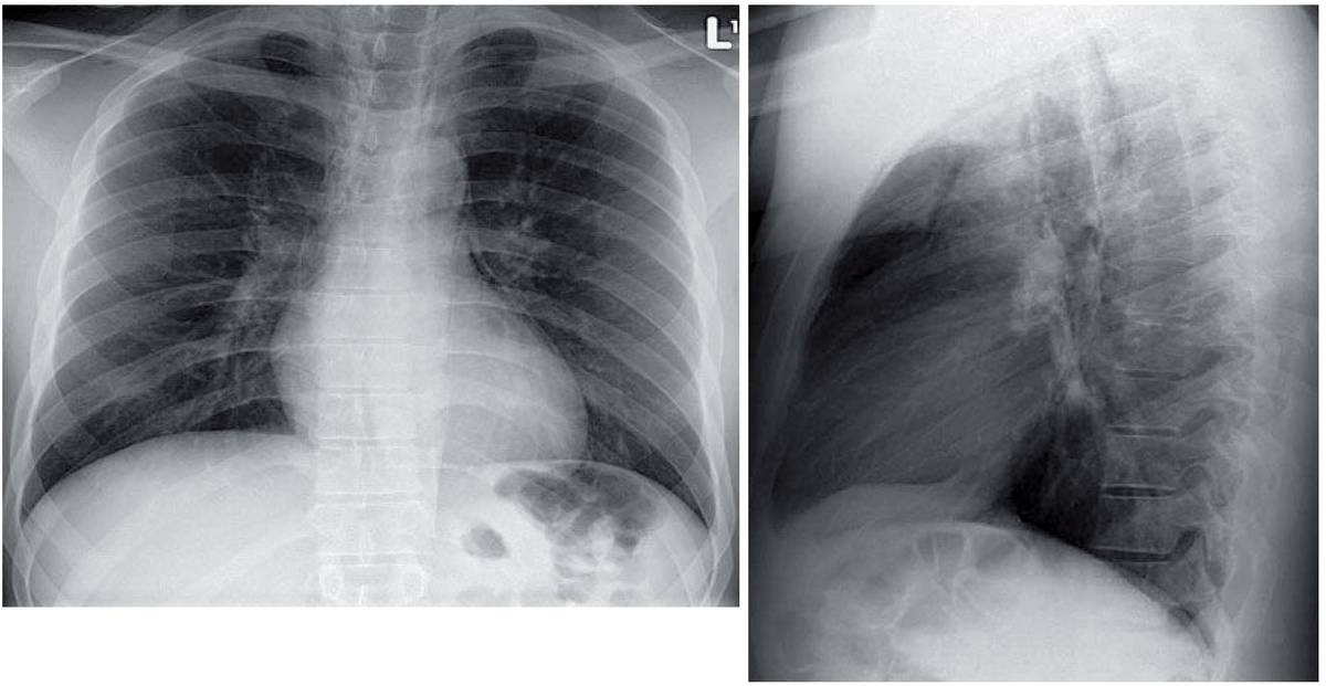 22-year-old Man With Severe Sudden Onset of Chest Pain - Manual of Medicine