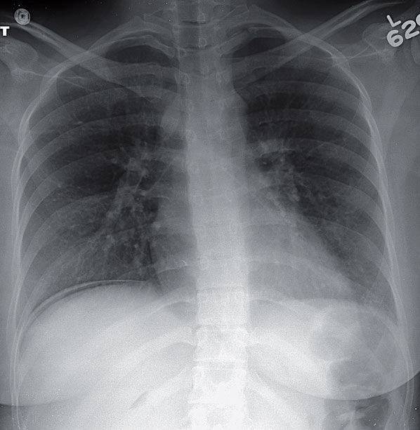 26-year-old Woman With Sudden Onset of Chest and Shoulder Pain - Manual ...