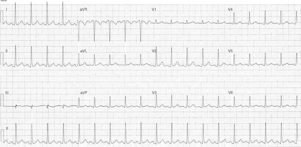 ECG Case 310 Interpretation - Manual of Medicine