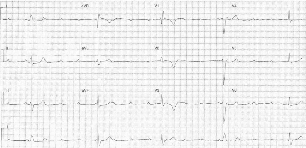 ECG Case 311 Intepretation - Manual of Medicine
