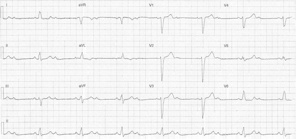 ECG Case 311 Intepretation - Manual of Medicine