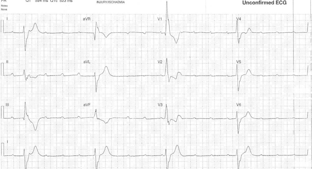 ECG Case 313 - Manual of Medicine