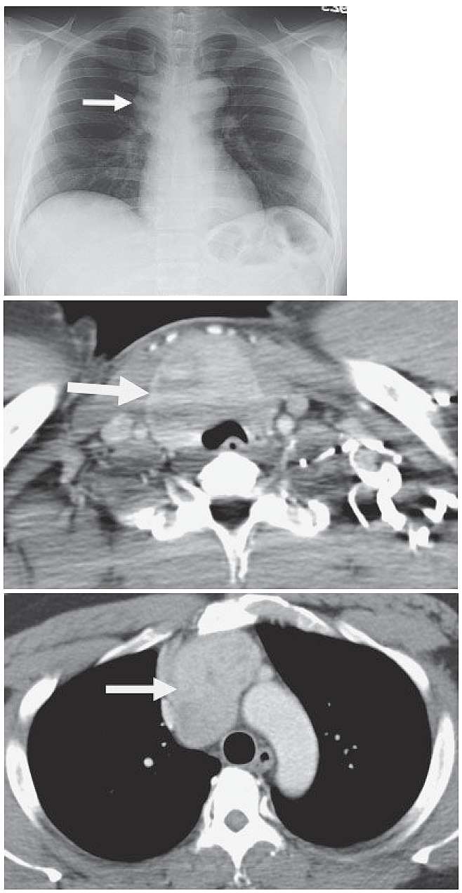 Intrathoracic Goiter - Manual of Medicine